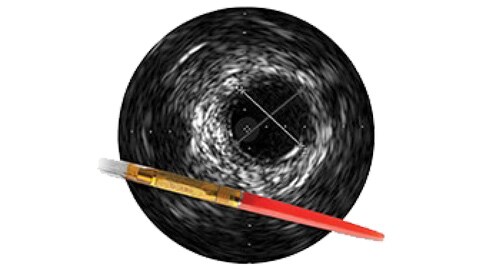 IVUS - Intravascular Ultrasound | Philips