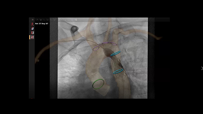 Congenital Heart Disease (CHD) | Philips Healthcare