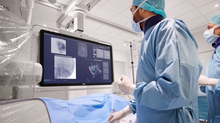 Ischemic Stroke Treatment | Philips Healthcare
